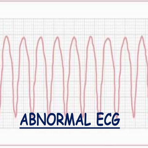 Normal Vs Abnormal Ecg