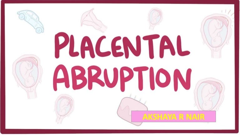 Abruptio placenta including nursing management.