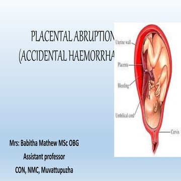 Abruptio placentae ppt | PPTX