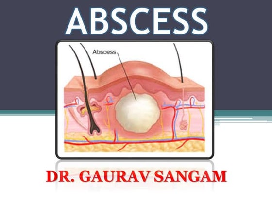 Abscess | PPTX | Ear, Nose and Throat Conditions | Diseases and Conditions