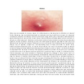 Abscess: Causes and Treatments