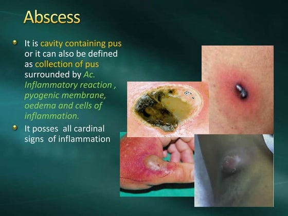 Pyaemic abscess by Dr.K.AmrithaAnilkumar | PPT
