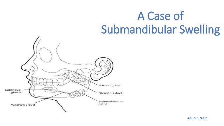 A case of submandibular swelling