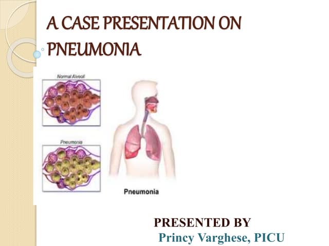 CASE PRESENTATION ON PNEUMONIA | PPTX