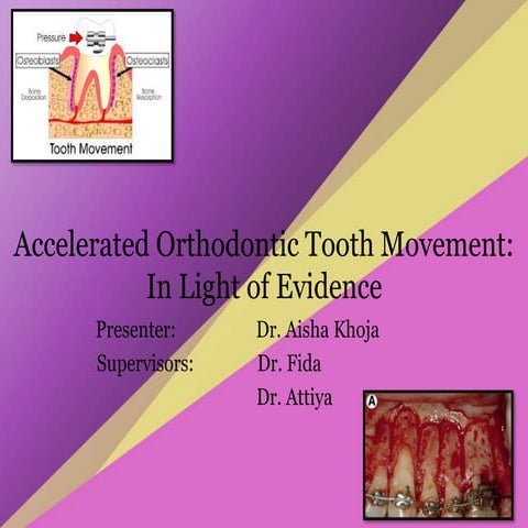Accelerated orthodontic tooth movement | PPTX