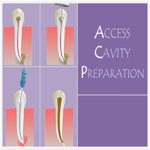 Endodontic Access Cavity Preparation Design Ppt