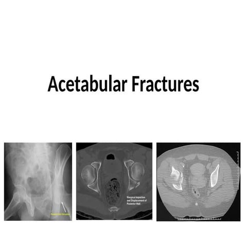 Acetabular Fractures a very brief summary | PPTX