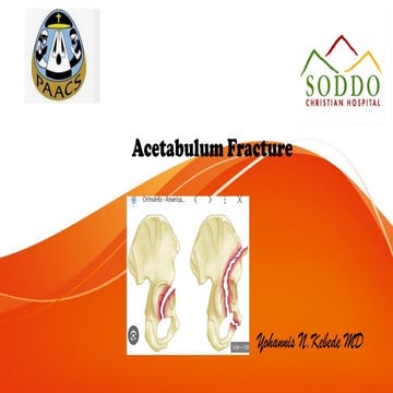 Acetabulum Fracture treatment and classification | PPTX