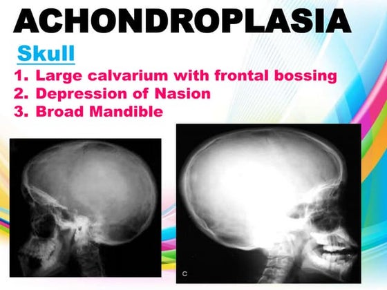 Acromegaly 1 | PPT