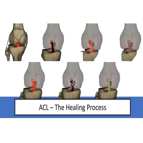 ACL healing presentation.pptx