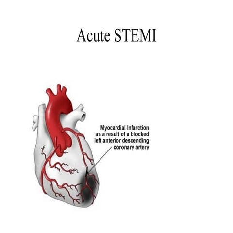 MANAGEMENT OF STEMI IN MALAYSIA(CPG).pptx