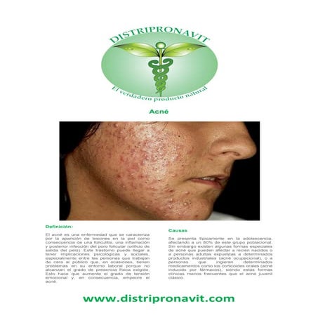 caso clinico de dermatologia de acne fulminas | PPTX