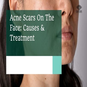 Acne Scars On The Face Causes & Treatment | PPTX