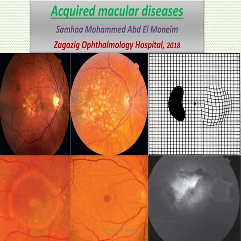 Choroidal neovascular membranes (CNVM) | PPTX