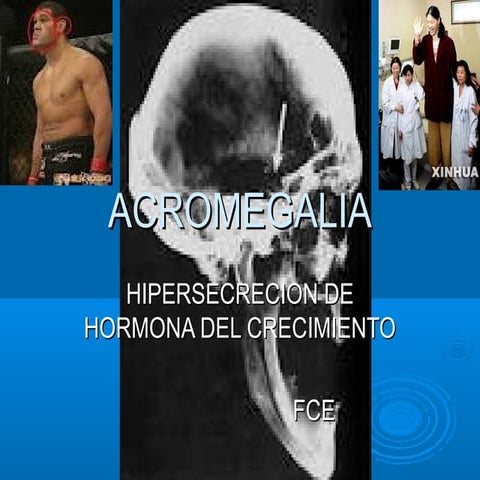 ACROMEGALIA SEMIOLOGIA DE MEDICINA INETRNA | PPTX