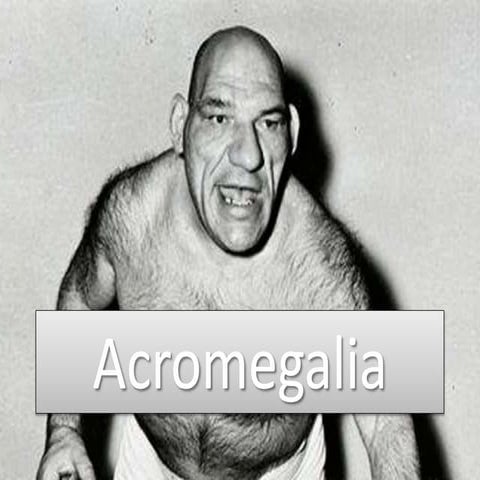 Acromegalia | PPT