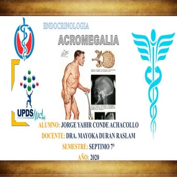 Acromegalia | PPTX