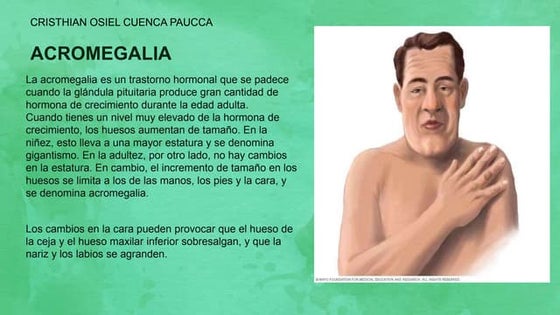 Acromegalia hist1 | DOC