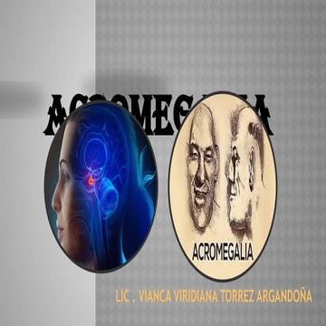 Acromegalia.pptx causas tratamiento y dx | PPTX