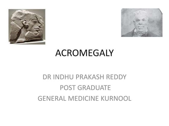 Gordon Acromegaly Poster 3-21-16 Final | PPT