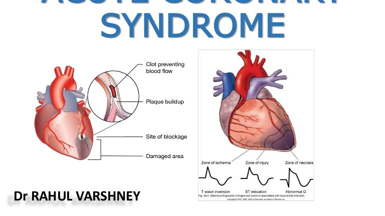 Acute Coronary Syndrome - Overview
