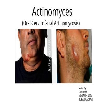 Actinomyces bacterial infections imp isre | PPT