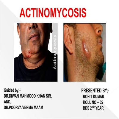 Actinomycosis | PDF | Ear, Nose and Throat Conditions | Diseases and ...