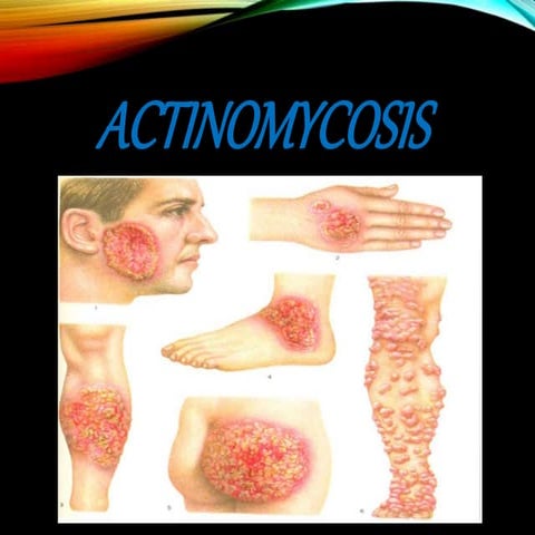 Actinomycosis Information | PPT
