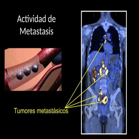 ACTIVIDAD METASTASIS DE LOS ORGANOS DEL CUERPO HUMANO.ppt
