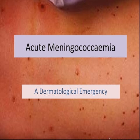 Acute Meningococcaemia | PPT
