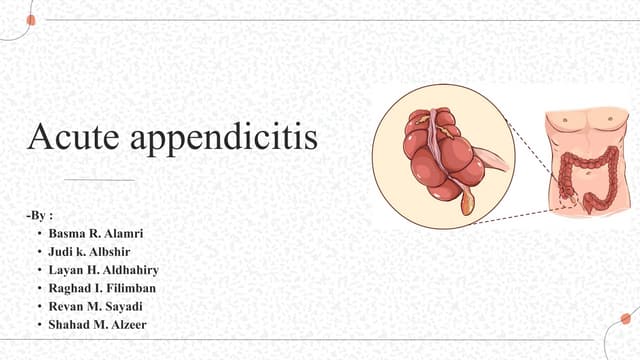 Acute Appendicitis | PPTX