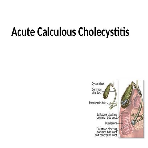 acute calculous cholecystitis, its pathogenesis and management | PPTX