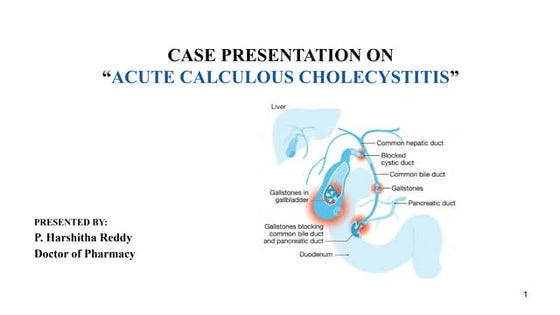 case 2 Acute calculus Cholecystitis dm sri.docx