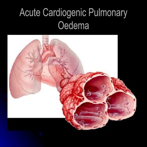 Cardiogenic Pulmonary Edema
