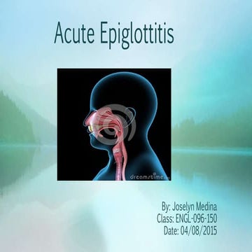 Acute epiglottitis by Joselyn | PPTX