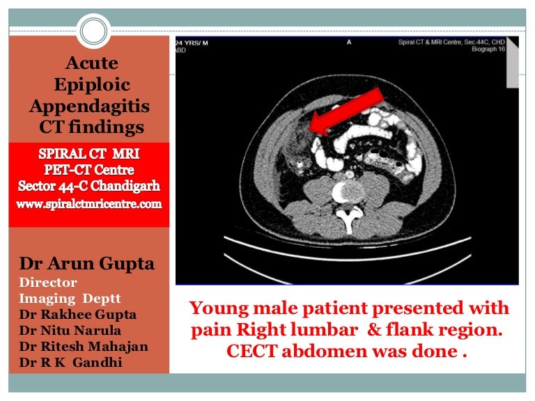 Acute Epiploeic Appendagitis Pptx2