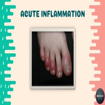 Acute inflammation - Pathology #X_patho | PDF