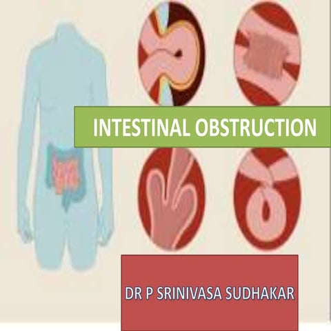 ACUTE INTESTINAL OBSTRUCTION.pptx