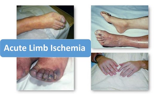 Acute Limb Ischemia | PPT