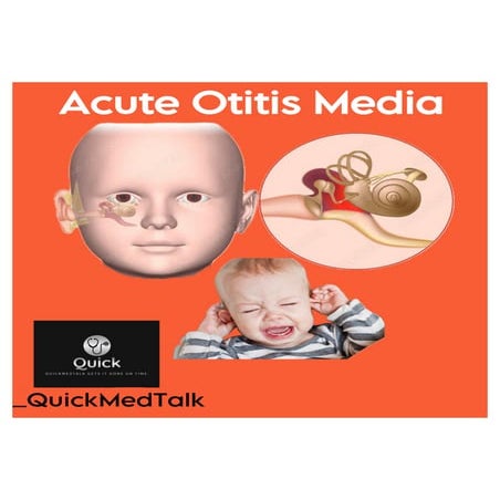Acute otitis media .pdf ENT BY QUICKMEDTALK | PDF
