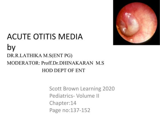 Otitis media | PPTX