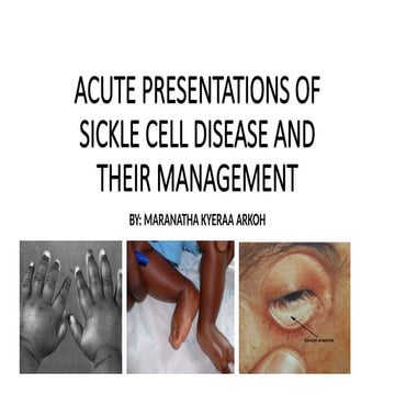 ACUTE PRESENTATIONS OF SICKLE CELL AND THEIR MANAGEMENT.pptx 2.pptx