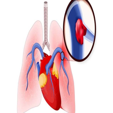 Acute pulmonary embolism and its management. | PPTX