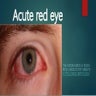 Acute red eye | PPTX | Eye and Vision Conditions | Diseases and Conditions