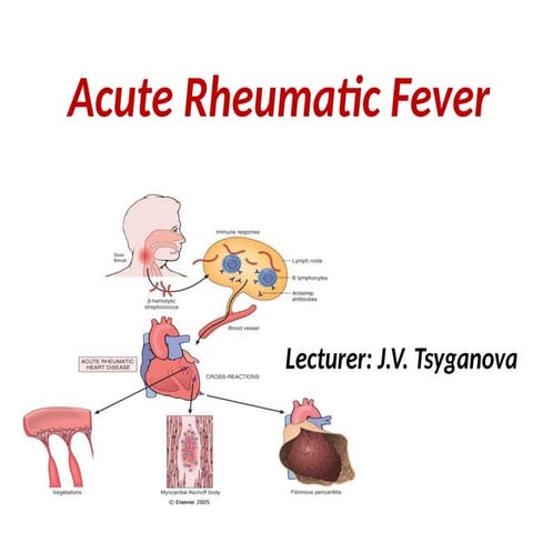 Acute Rheumatic Fever | PPTX