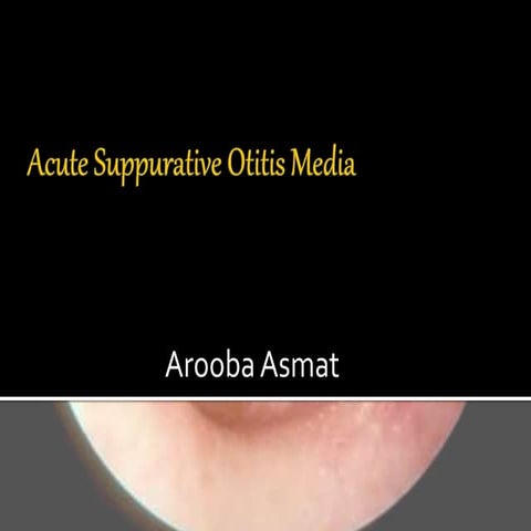 Acute suppurative otitis media | PPTX