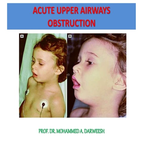 Acute upper airways obstruction 20-21.pptx