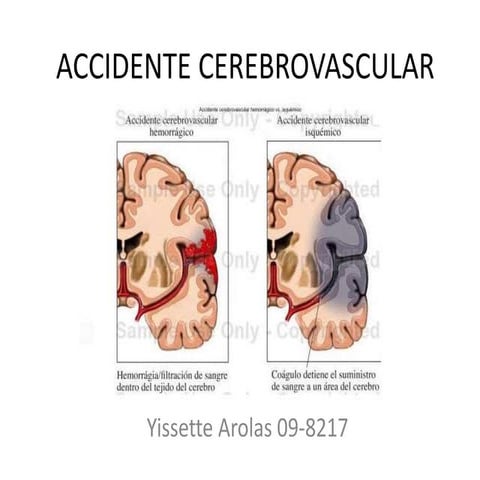 Acv | PPTX