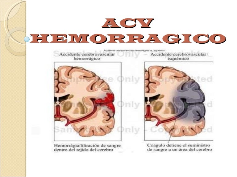 Acv hemorragico
