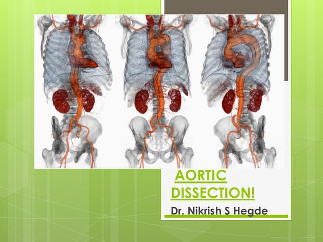 Aortic dissection | PPTX